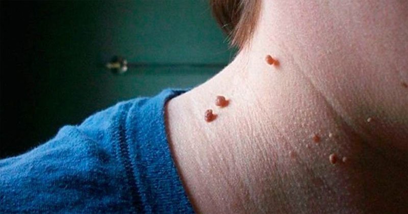 ️ Elimina Protuberancia Axilar ¡Ahora! ⚡ InfoAxilas